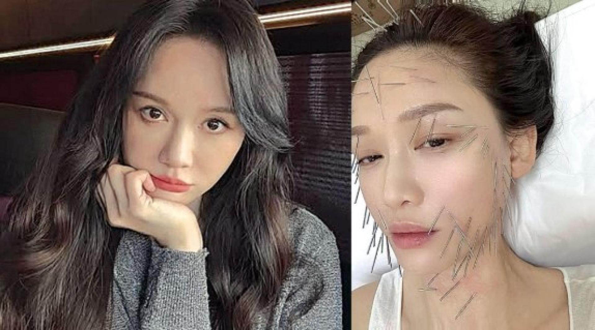 Revealing Close-up Photo of Her Body Full of Needles: Chen... - United ...